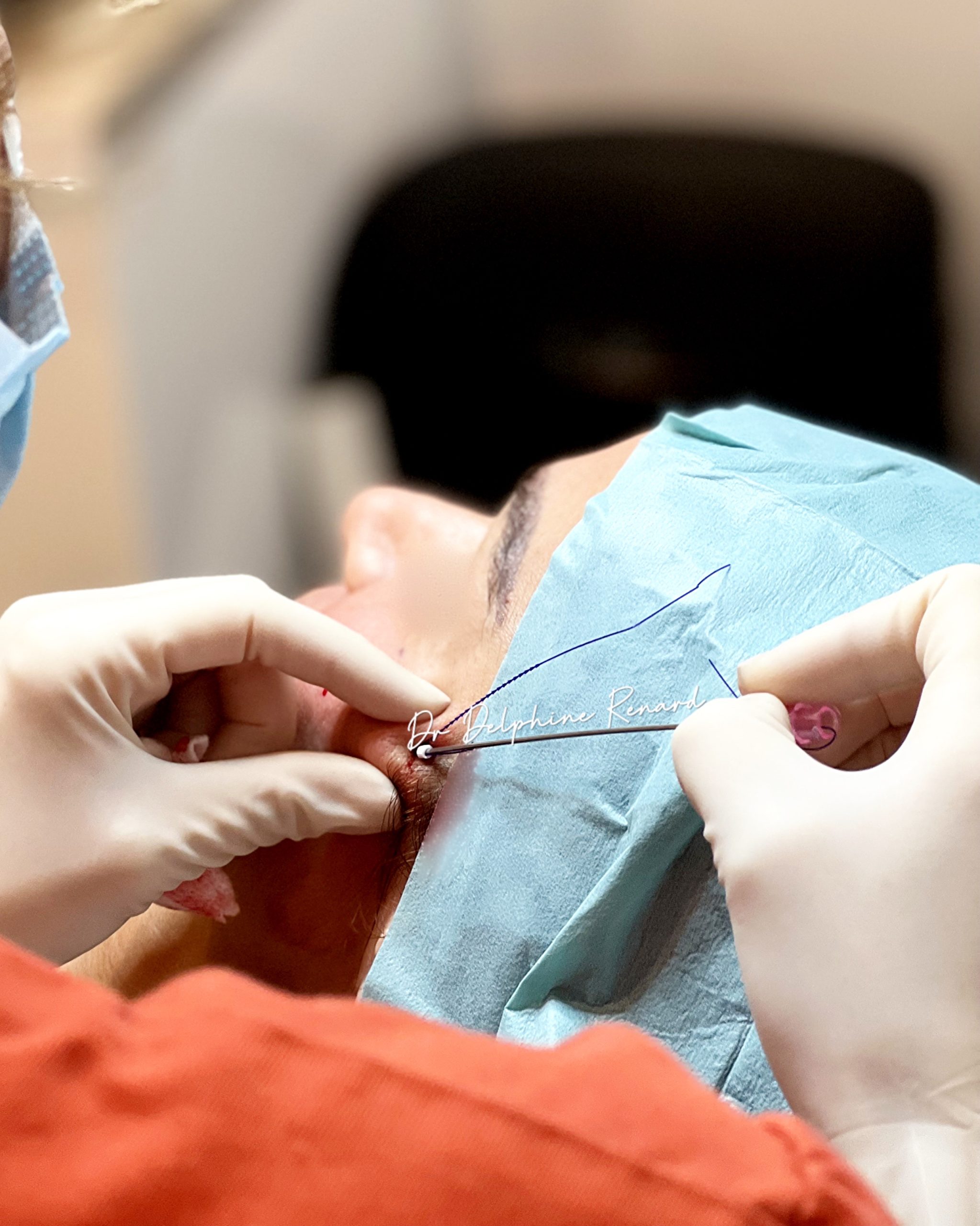 Fils tenseurs résorbables - Dr. Delphine Renard